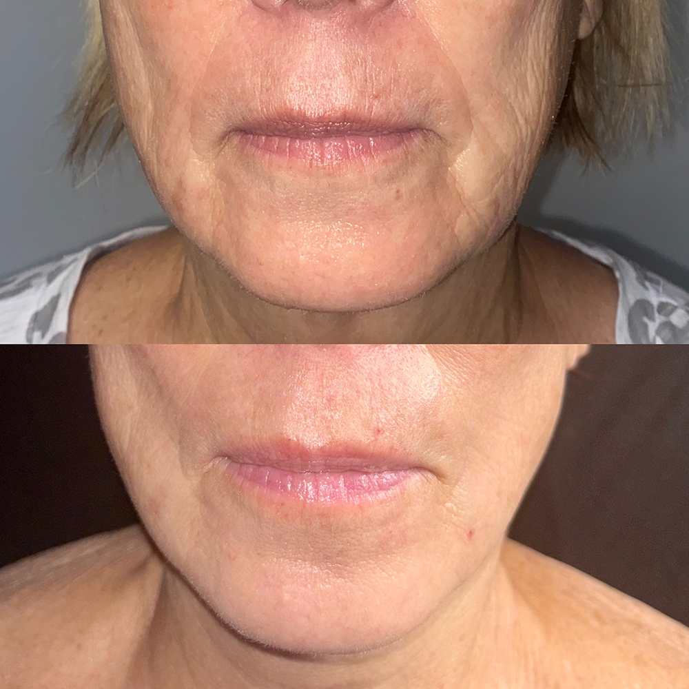 Skin Renewal – Rockford, IL - Circle of Wellness